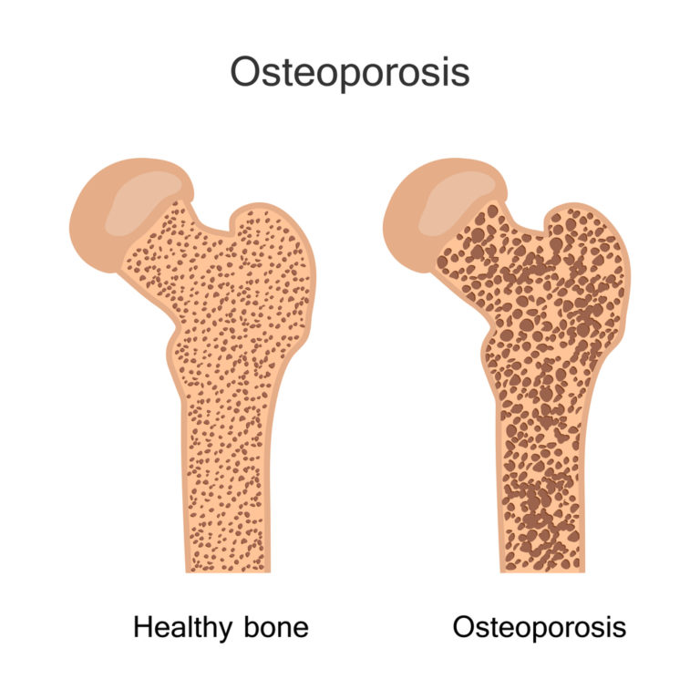 Osteoporosis Screening University Diagnostic Medical Imaging Osteoporosis Screening University Diagnostic Medical Imaging